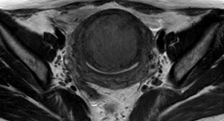 Endocavitary After UAE