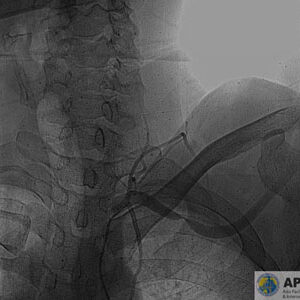 Thoracic Outlet Syndrome