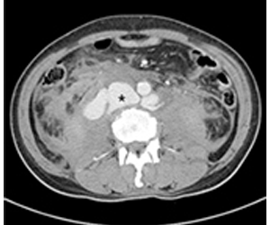 Interventional treatment