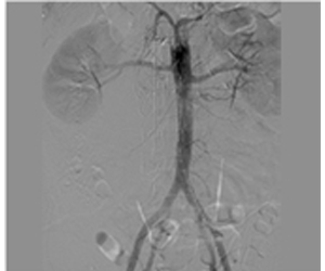 Interventional treatment