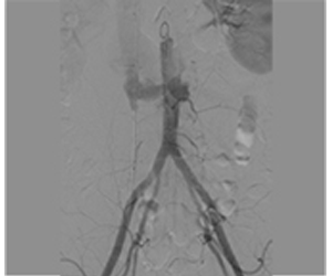 Interventional treatment