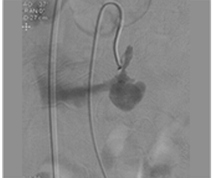 Interventional treatment