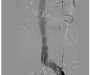 Interventional treatment